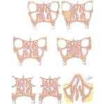Types of Deviated Septum