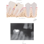 Dental Caries