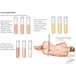 Lumbar Puncture