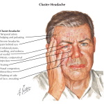Cluster Headache
