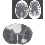 Acute Disseminated Encephalomyelitis (ADEM) and Multiple Sclerosis ...