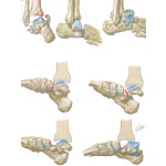 Fractures and Dislocations of Talus