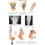 Dislocation of the Lunate