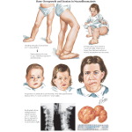 Bone Overgrowth and Erosion in Neurofibromatosis