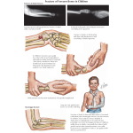 Fracture of Forearm Bones in Children