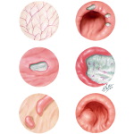 Gastroscopic Diagnosis Of Malignant Disease