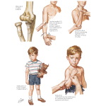 Dislocation and Subluxation of the Radius