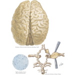 Cerebral Arteriosclerosis