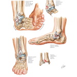 Major Sprains and Sprain Fractures
