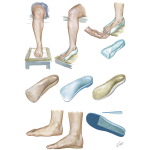 Technique of Fitting Prescription Orthotic Device: Some Types of ...