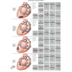 Localization of Posterior Infarcts