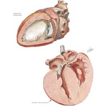 Endocardial Fibroelastosis and Glycogen Storage Disease