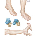 Hypermobile Flatfoot