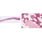 Light Micrograph of a Bone Marrow Biopsy Specimen at Low (Above) and ...