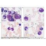 Bone Marrow Smears Showing Different Stages of Granulocytopoiesis