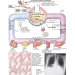 Posttraumatic Pulmonary Insufficiency (Adult Respiratory Distress ...