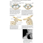 Congenital Anomalies of Occipitocervical Junction