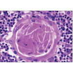 Light Micrograph of Hassall’s Corpuscle at Higher Magnification