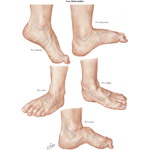 Foot Deformities