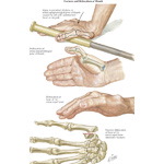 Fractures and Dislocations of Thumb