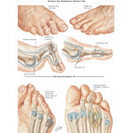 Hammer Toe, Bunionette, Morton's Toe