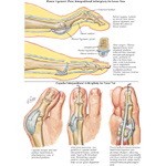 Plantar Ligament (Plate) Interpositional Arthroplasty for Lesser Toes ...