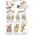 Rupture of Posterior Cruciate Ligament