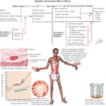 Metabolic and Systemic Effects of Burns