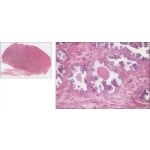 Light Micrograph of Part of the Prostate With Light Micrograph of the ...