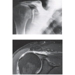 Conditions of the Rotator Cuff