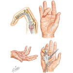 Tendons of the Fingers