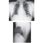 Radiographic Anatomy of the Thorax