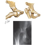Hip Joint