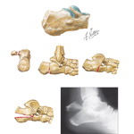 Calcaneus