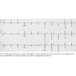 Ectopic Atrial Rhythm