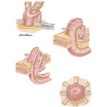 Types of Stomas: Loop and Ileostomy Technique