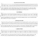 Abnormal Cardiac Rhythms