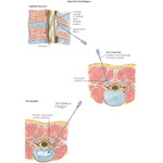 Injection Techniques
