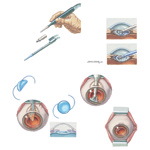 Phacoemulsification and Insertion of Flexible Intraocular Lens (IOL)