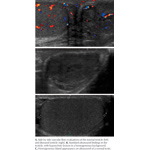 Ultrasound Findings In the Testicle