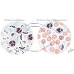 Malaria: Clinical Course and Diagnosis