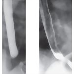 Esophagogastric Junction