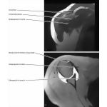 Subscapularis Muscle