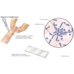 Nosocomial Infections: Diagnosis of Candida Sepsis