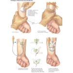 Nosocomial Infections: Technique of Intravenous Line Introduction