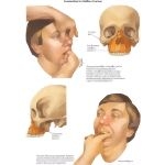Facial Trauma: Examination for Mid-Face Fracture