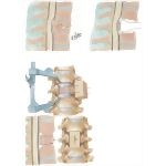 Block Fusion for Types 2 and 3 Compression Fractures of Cervical Spine