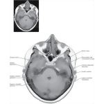 Axial (Horizontal) Sections Through the Forebrain: Level 1 - Mid Pons