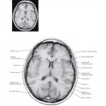 Axial (Horizontal) Sections Through the Forebrain: Level 7 - Basal ...