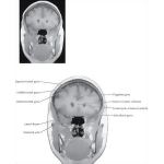 Coronal Sections Through the Forebrain: Level 1 - Genu of Corpus Callosum